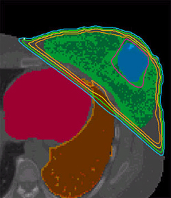Carefully Mixed Radiation Cocktail Reduces Collateral Damage In Breast ...