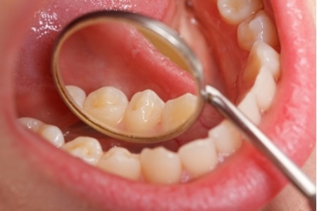 VELscope Visualization Device Helps Early Detection Of Oral Cancer