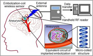 UBC Researchers Devise New Technology To Monitor Brain Aneurysms