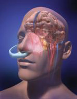 BeneChill's RhinoChill System Receives CE Marking For European ...