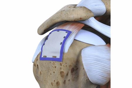 Smith Nephew Acquires Tissue Regeneration Technology For Shoulder Repair