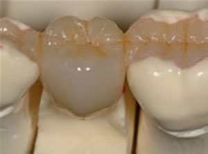 Fibers Used In Bullet-Proof Vests Quadruple Toughness Of Dental Composites