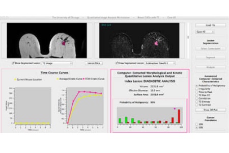 Computer-Aided Image Analysis Aims To Offer 'Second Opinion' In Breast ...
