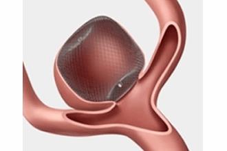 Terumo Acquires Sequent Medical US-Based Developer Of New Aneurysm ...