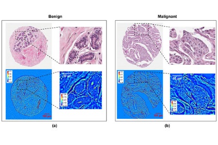 New Optical Method Promises Faster More Accurate Diagnosis Of Breast Cancer