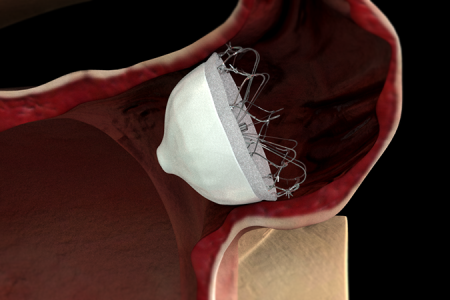 JJs Biosense Acquires WaveCrest LAA Closure Device Developer