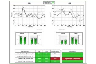 Visual Field Testing Falls Short For Early Glaucoma Patients Earlier ...