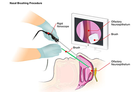 Nasal Test For Human Prion Disease May Accelerate Search For A Cure