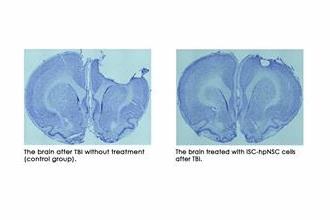 International Stem Cell Corporation To Move Forward With Traumatic ...