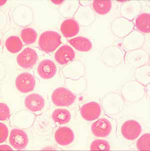 Fetal Hemoglobin - Differential Staining Kit