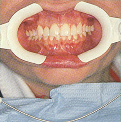 Cheek and Lip Retractor