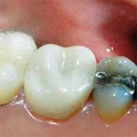 Temporary/Provisional Crowns