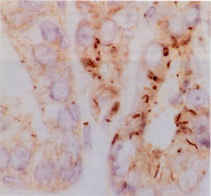 News from ASCB: Centrosomes may provide clues to cancer prognosis