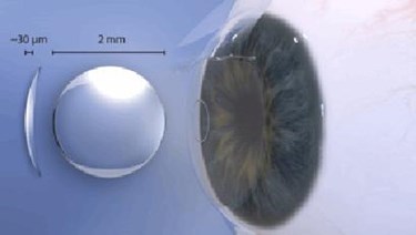 FDA Approves First Eye Implant To Reshape Cornea To Treat Presbyopia