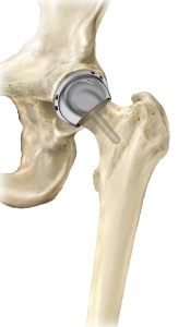 New Industry Data Demonstrates The Superiority Of The BIRMINGHAM HIP ...