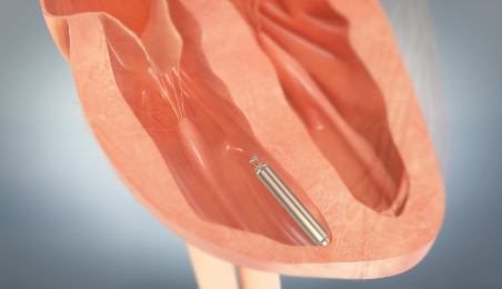 First Leadless Pacemaker In United States Implanted Into A Patient At ...