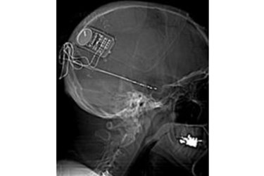 URMC Plays Role In New Epilepsy Technology