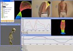 Motion Capture With AVT Cameras Makes Orthopedic Diagnosis Easier