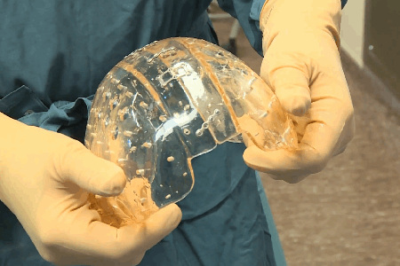 Dutch Woman Receives 3D Printed Full Skull Implant