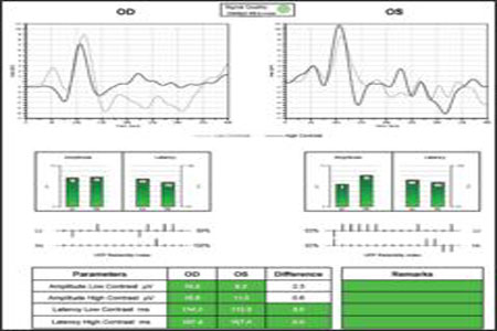 Diopsys NOVA-VEP Used For Early Glaucoma Detection