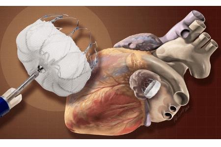 Device For Irregular Heartbeat May Be More Cost-Effective Than Medication