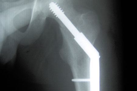 Biodegradable Metal Implants Could Cut Costs Of Secondary Surgeries