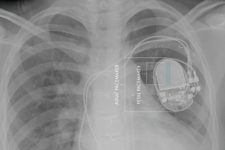 Researchers Develop First Fully Implantable Fetal Pacemaker