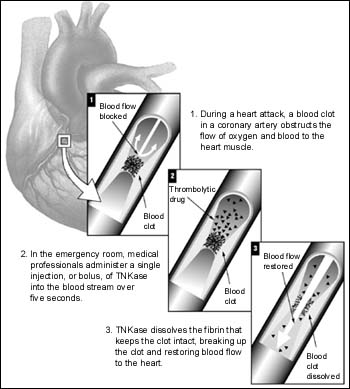 Genentech's Heart Attack Treatment Approved by FDA