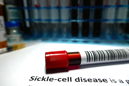 Tessera Therapeutics Advances In Vivo Gene Therapy For SCD